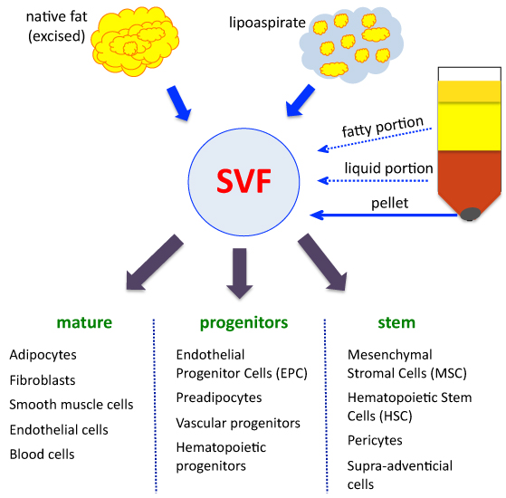 Human stromal vascular fraction (hSVF, from obesity adipose tissue)